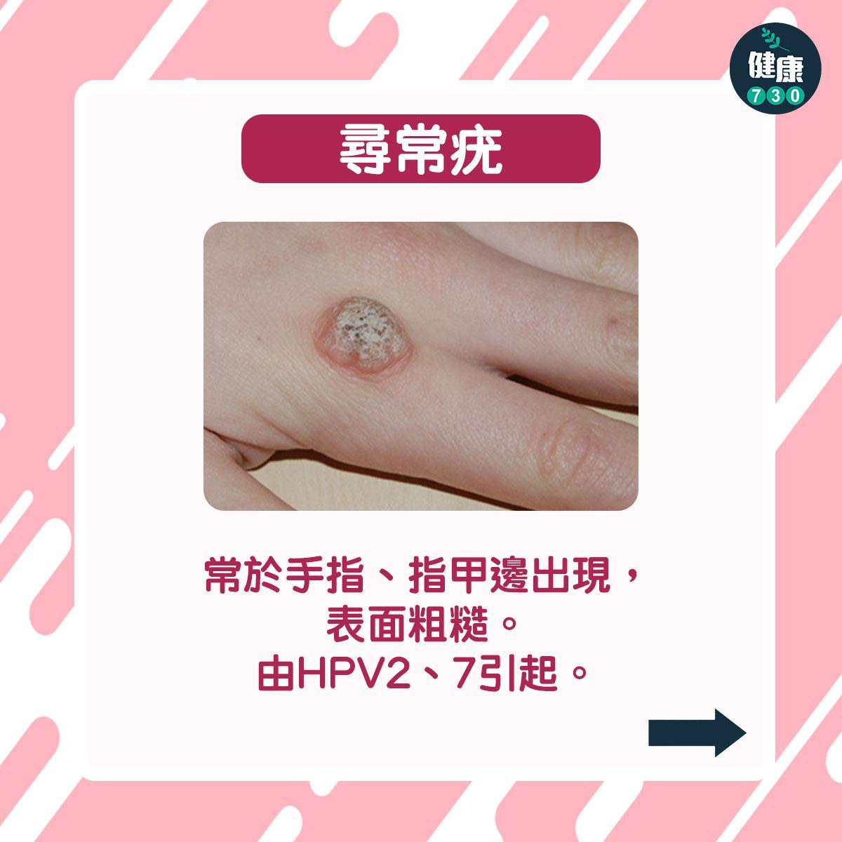 HPV疫苗｜17-21歲香港女性居民免費接種計劃 有效預防子宮頸癌 | am730