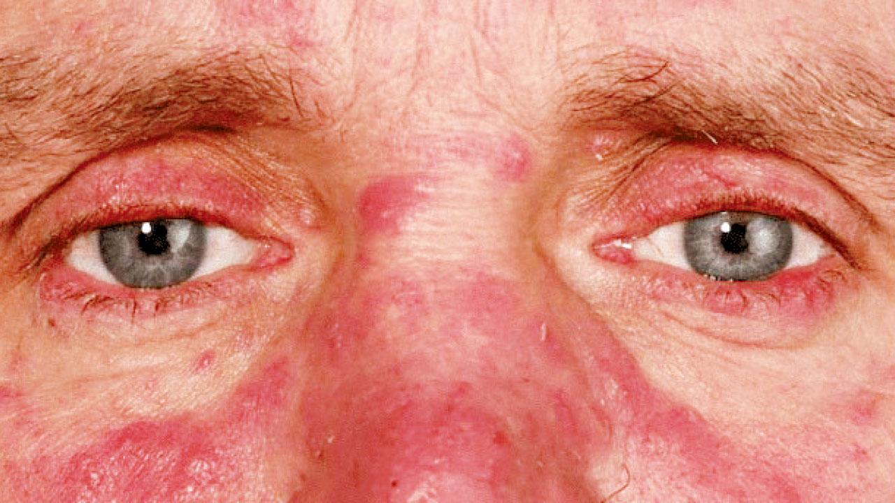 玫瑰痤瘡 影響眼睛 | am730