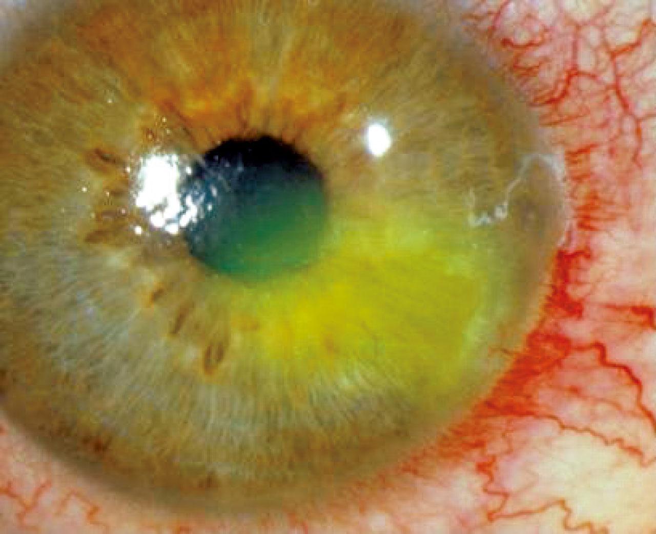 角膜受損如何處理？ | am730