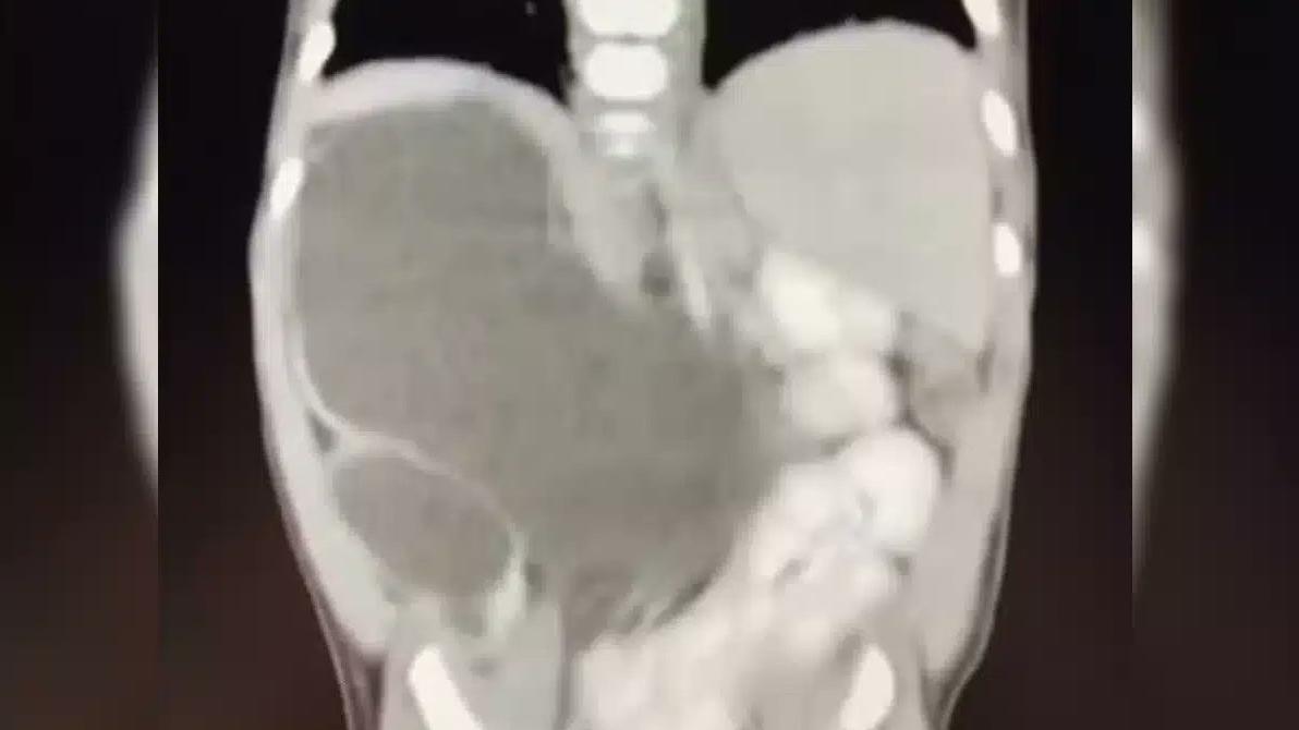 巴西女嬰天生4個腎 醫生驚訝：全球不到100例 | am730