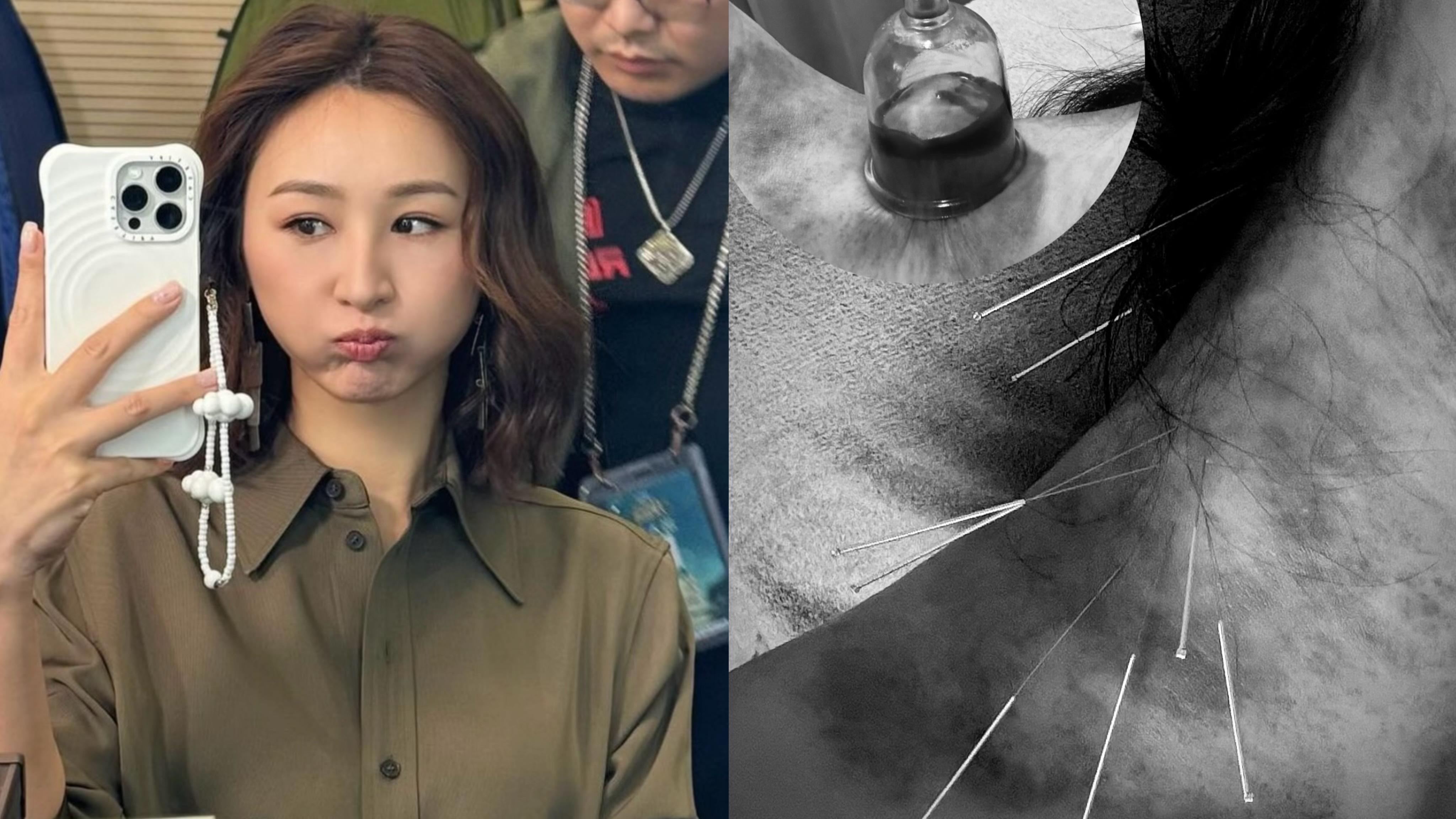 高海寧身體響警號 頸背突現兩粒硬塊 | am730