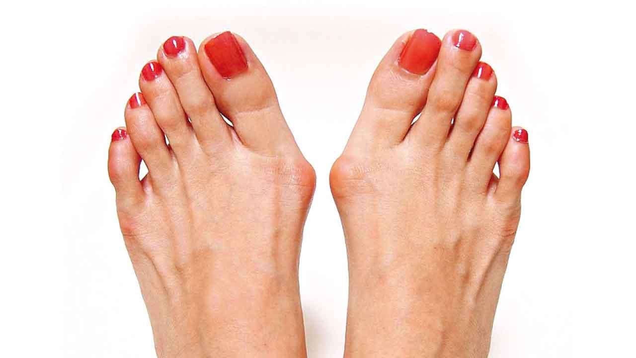 改善拇趾外翻要着好鞋 | am730